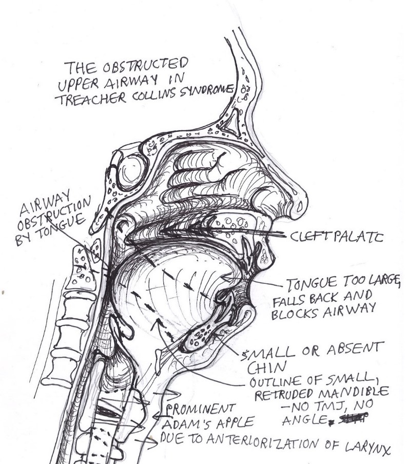 TREACHER - COLLINS SYNDROME